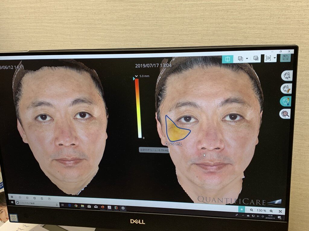 新型3Dカメラいろいろ | 東京皮膚科・形成外科 入谷 英里ブログ